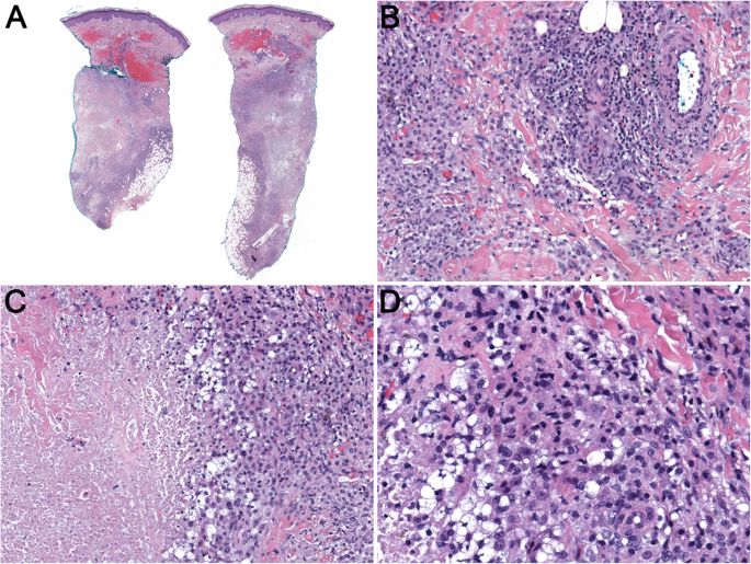 Dermale sarcoom: alles over huidziekten en behandelingen
