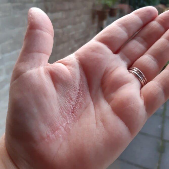 Behandeling van Eczeem aan je Handen: Tips en Advies
