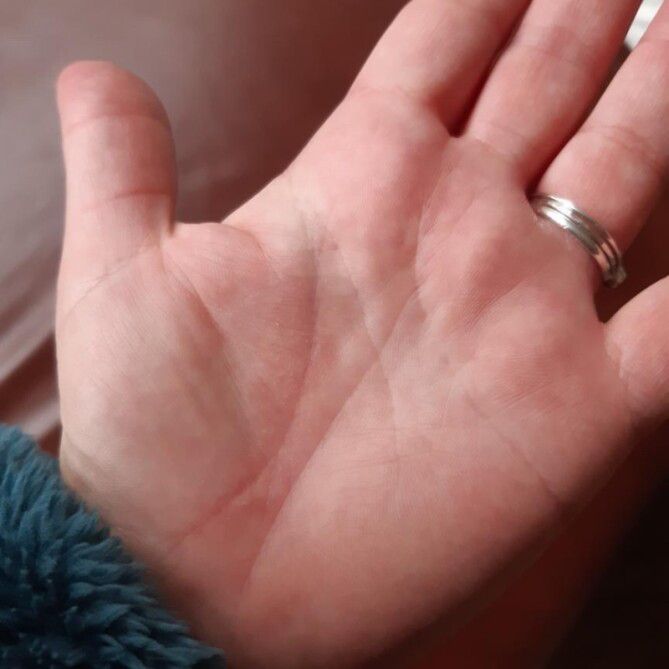 Eczeem op Handen: Oorzaken, Symptomen en Behandelingen