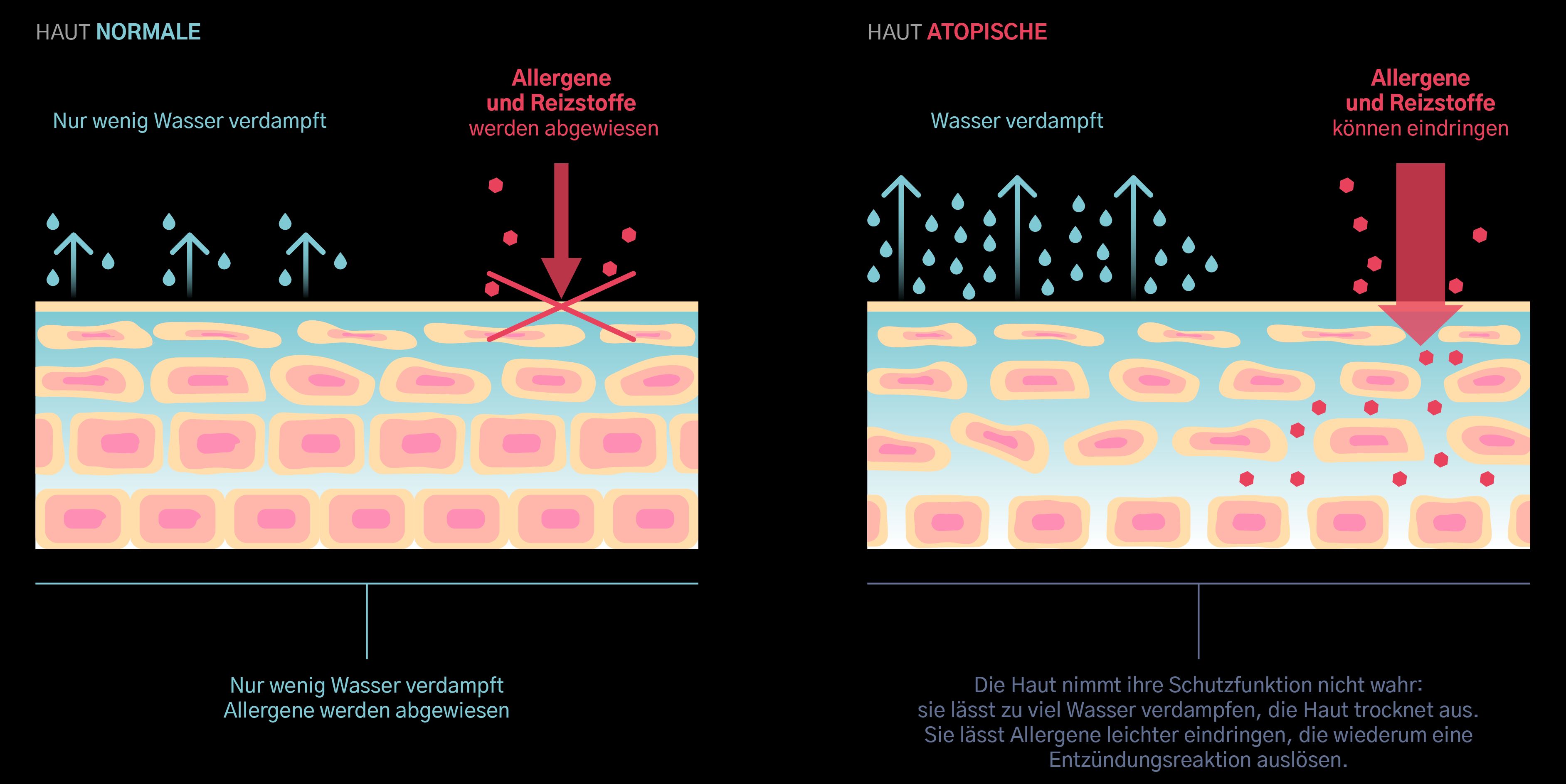 Alles wat je moet weten over Atopische Dermatitis: Symptomen, Oorzaken ...