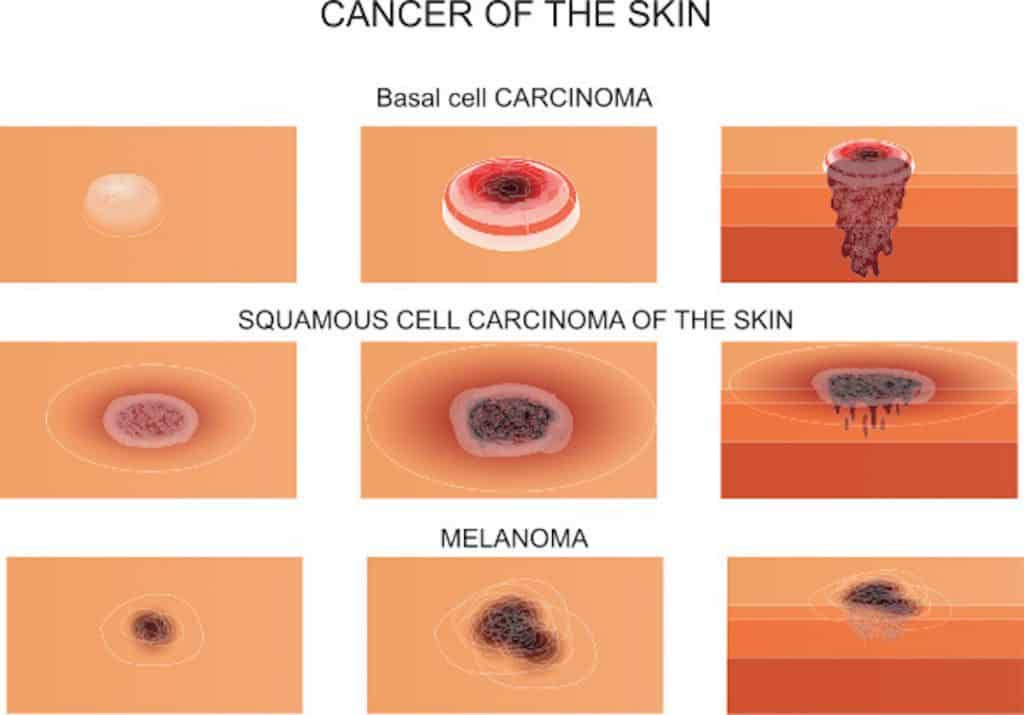 Hoe weet je of je huidkanker hebt? Ontdek de Tekenen en Symptomen