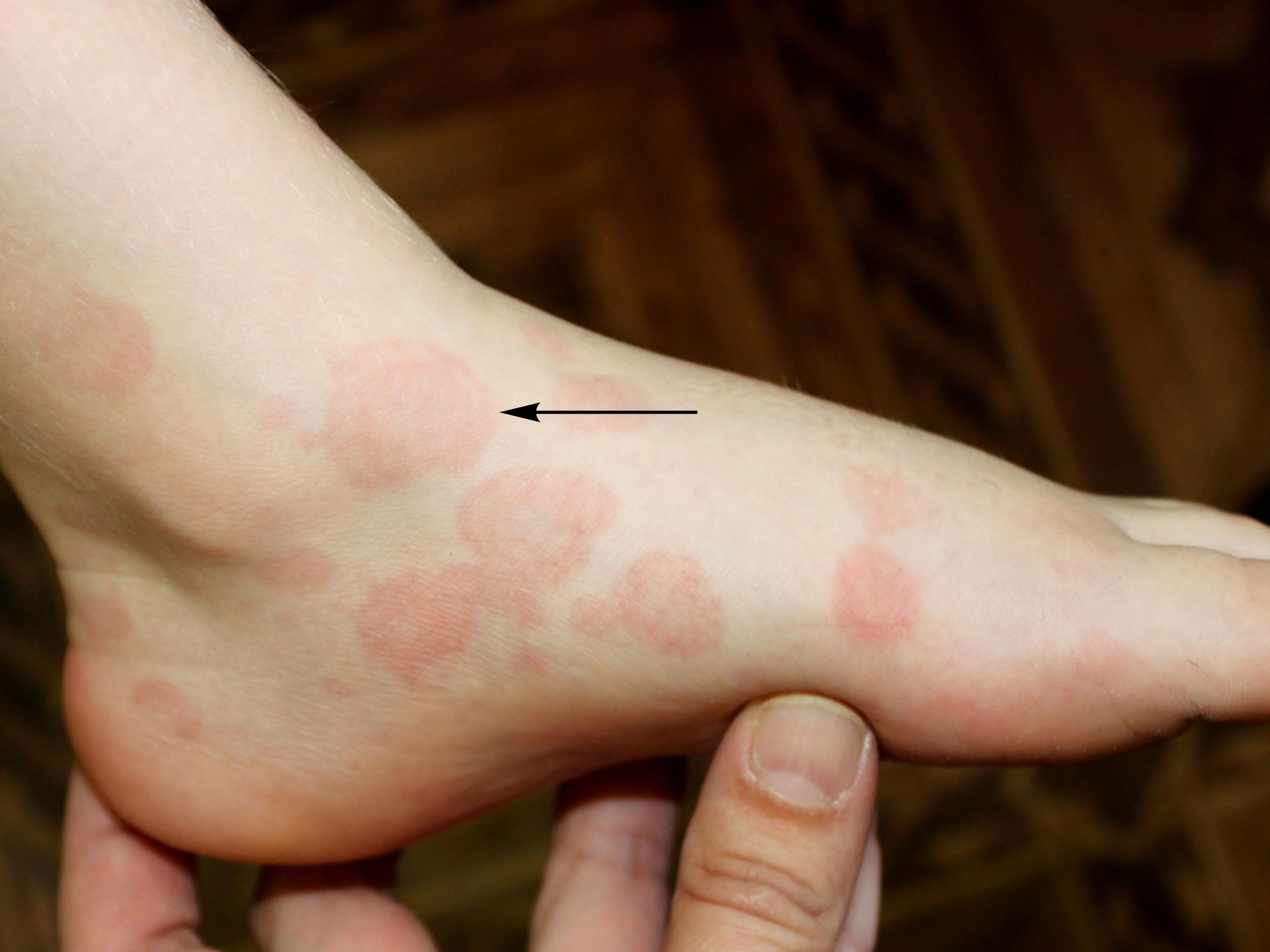 Huiduitslag op de Benen bij Volwassenen: Oorzaken, Symptomen en Behandeling