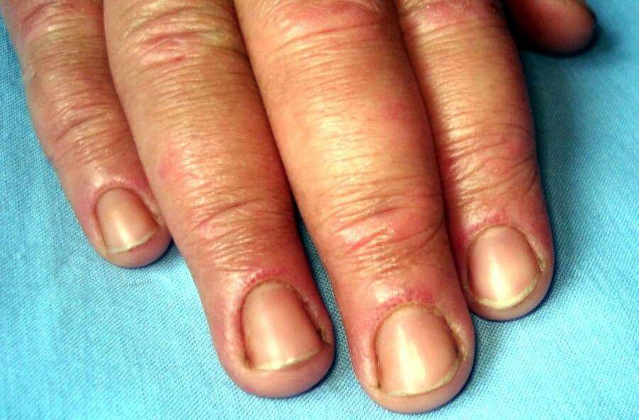 Huiduitslag door Auto-immuunziekten: Oorzaken, Symptomen en Behandelingen