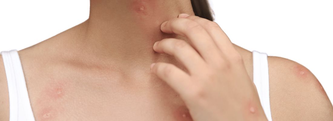 Hoe Herken en Behandel Je Een Huiduitslag Door Een Insectenbeet?