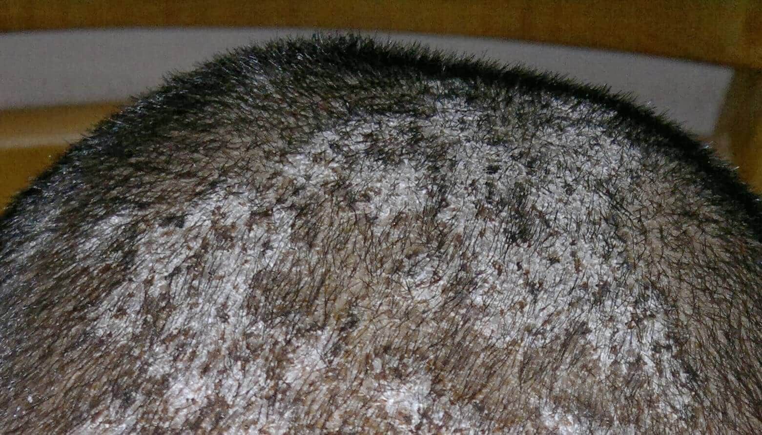 Huiduitslag in nek: Oorzaken, Behandelingen en Preventie