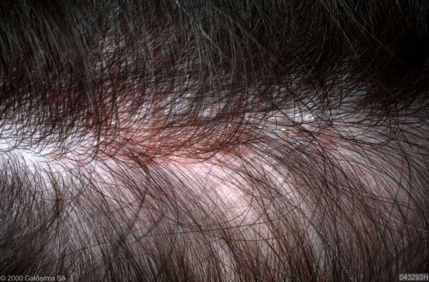 Huiduitslag in nek: Oorzaken, Behandelingen en Preventie