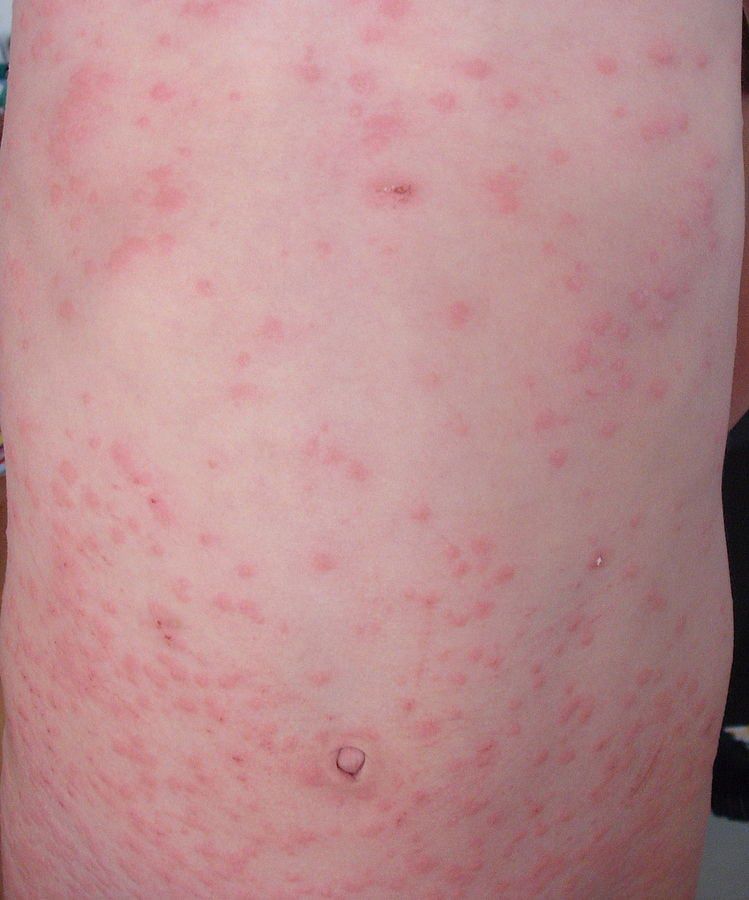 Wat te Doen bij Huiduitslag van de Eikenprocessierups? Symptomen en Behandeling