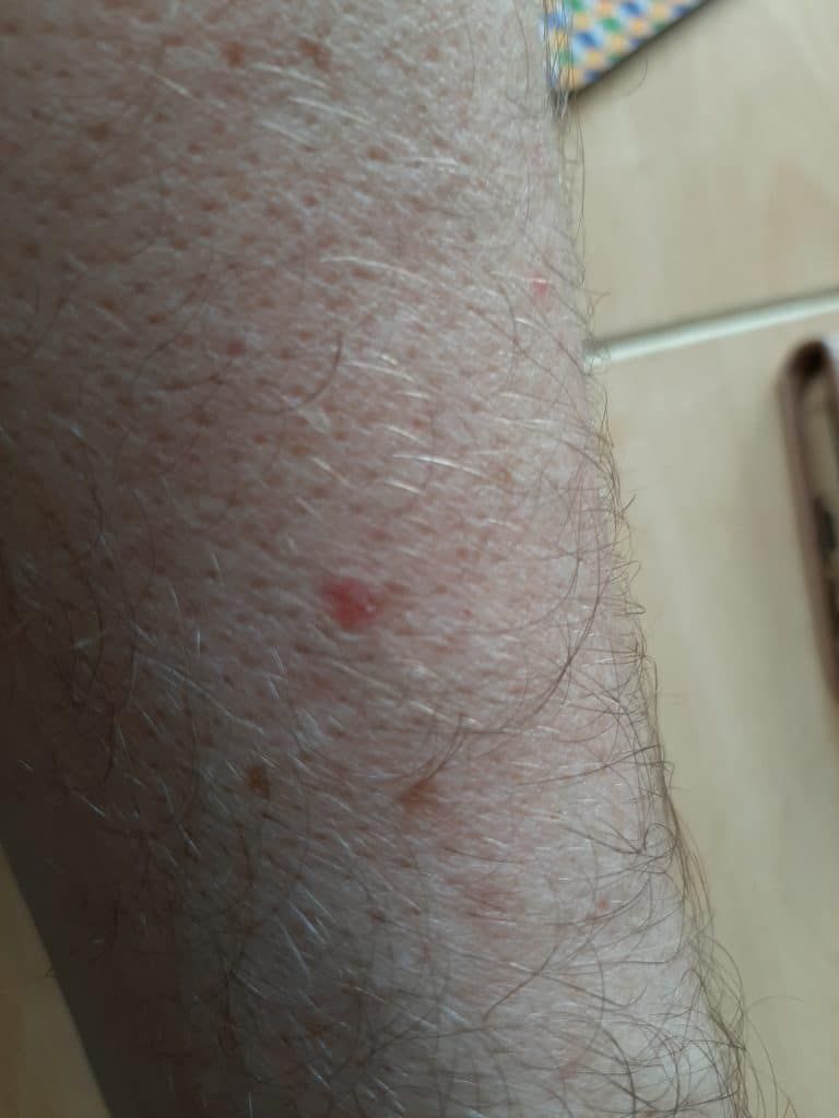 Oorzaken en Behandeling van Jeukende Huiduitslag op Benen: Tips en Adviezen