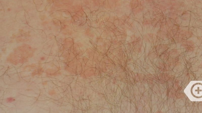 Wat is Neo Cutigenol Eczeem en Hoe Kan Het Behandeld Worden?