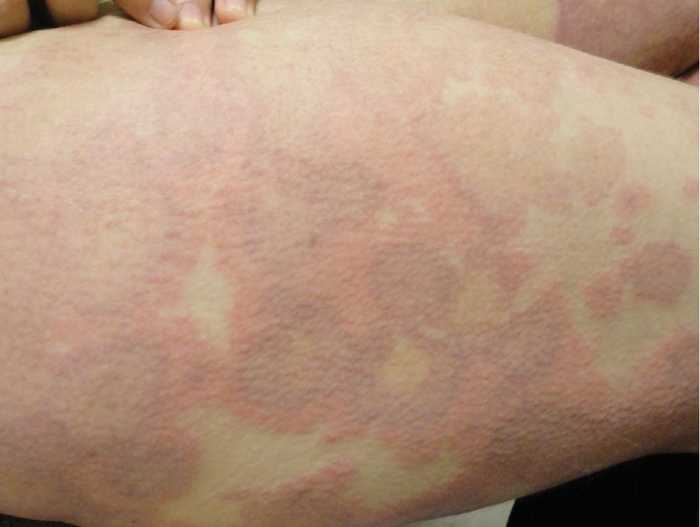 Rode Huiduitslag bij Volwassenen: Oorzaken en Behandelingen