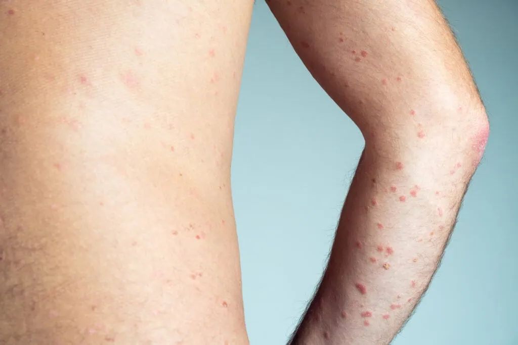 Stress huiduitslag jeuk: Oorzaken, Symptomen & Behandelingen