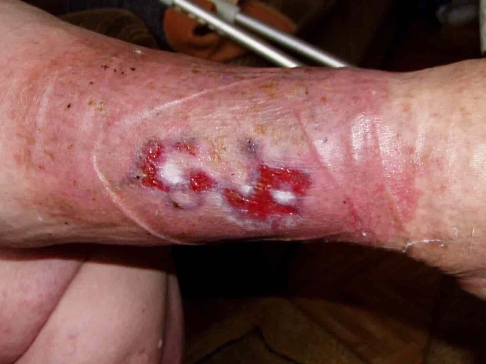 Alles over Ulcus Cruris Venosum | Huidziekten Verduidelijkt